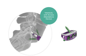 Anterior / Posterior Lumbar Fusion - NEUROSURGERY & SPINE GROUP